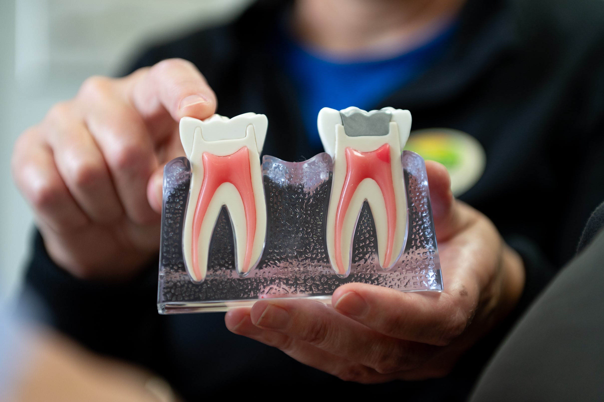 Inlay and onlay restorations - Valley View Dental